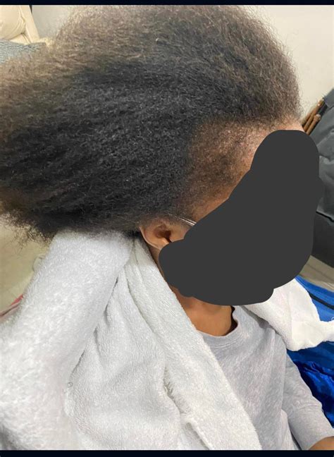 Anyone Else Have This Balding Pattern Completely From The Front Going