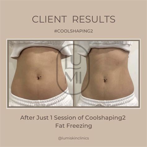 Fat Cavitation Before And After Is It Really Worth It