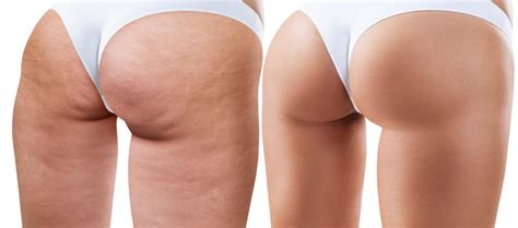 The Best Water Cellulite Pills Ranking Reviews And Prices