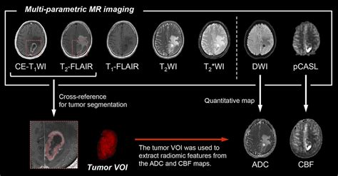 Radiomics Based Machine Learning Classification For Glioma G Journal Of Computer Assisted