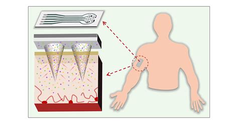Microneedle Coupled Epidermal Sensors For In Situ Multiplexed Ion Detection In Interstitial