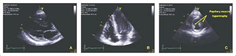 Doppler Echocardiography In A Patient With Fabry Disease A