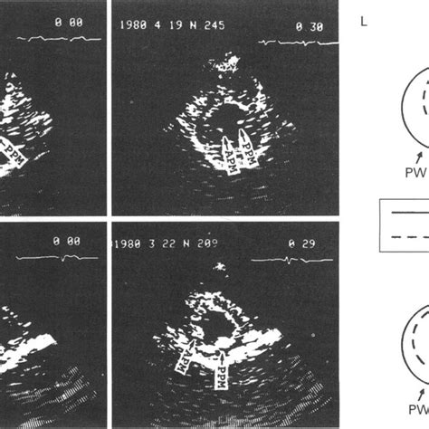 Cross Sectional Short Axis Echocardiograms Of The Left Ventricle In Two Download Scientific