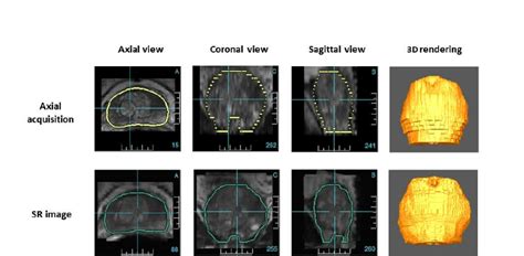 Segmentations Of The Original Axial Acquisition Top Row And The