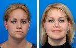 Asymmetrical Face Causes Fixes And Natural Solutions For Facial Symmetry