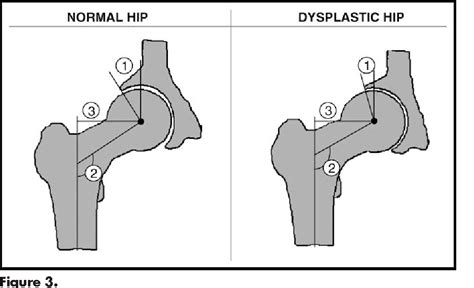 Figure 3 From Acetabular Labral Tears Semantic Scholar