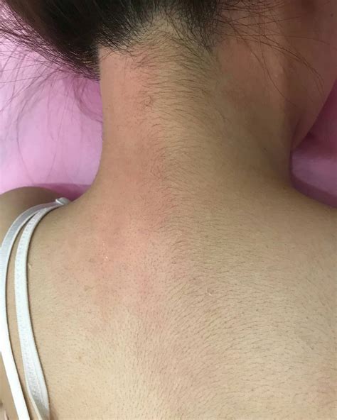 7days왁싱향남 이마랑 뒷목 왁싱 전 후 이번여름 깔끔하고 깨끗하게 머리묶고 다니세요