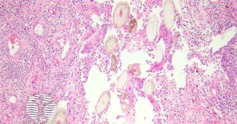 Pilonidal Sinus Pathology Image