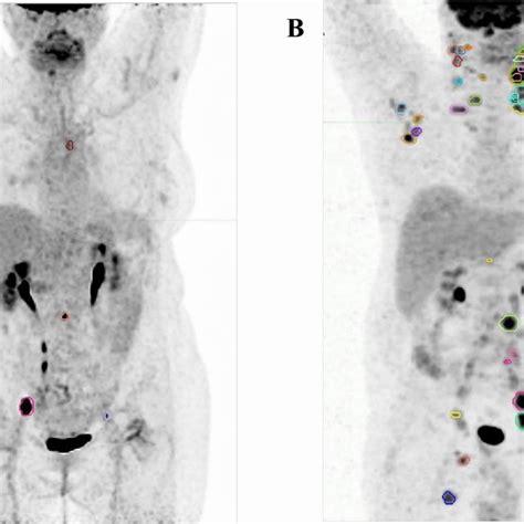 Total Metabolic Tumour Volume Tmtv And Whole Body Total Lesion Download Scientific Diagram