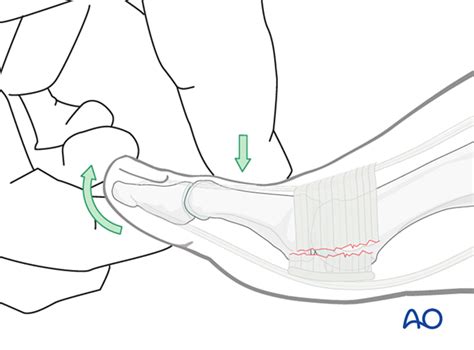 Crif K Wire Fixation For Mtp Joint Dislocation
