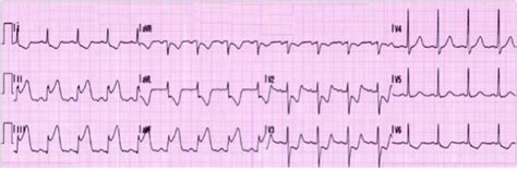 Ecg Showed Sinus Rhythm With St Segment Elevation In Leads Ii Iii And