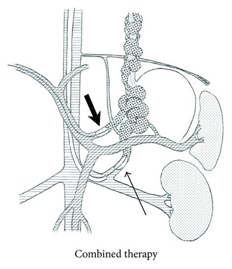 Schemas Of Percutaneous Transhepatic Obliteration And Combined Therapy Download Scientific