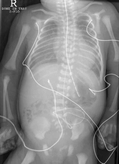 Chest And Abdomen Radiograph Demonstrating Multiple Vertebral Download Scientific Diagram