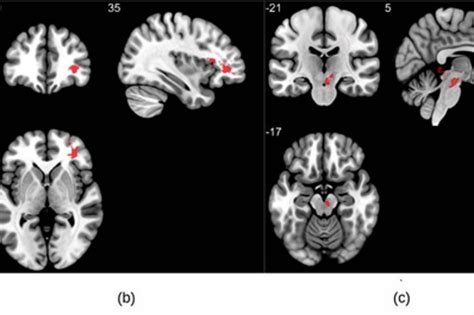 Mri Brain Abnormal