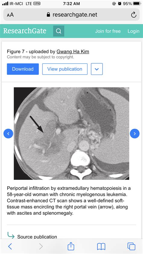 Diffuse Soft Tissue Swelling Mapasgmaes
