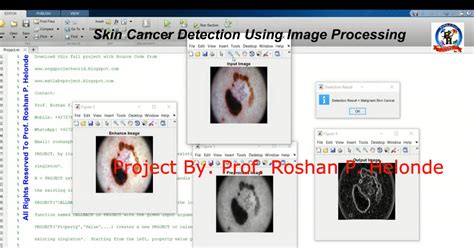 Skin Cancer Detection Using Image Processing Matlab Project With Source Code Skin Cancer