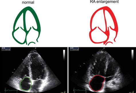Normal Right Atrial Volume Echocardiography Normal Values Ctmlae