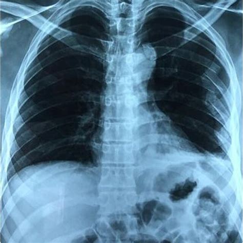 Postoperative Chest Radiograph Showing Small Pleural Effusion And