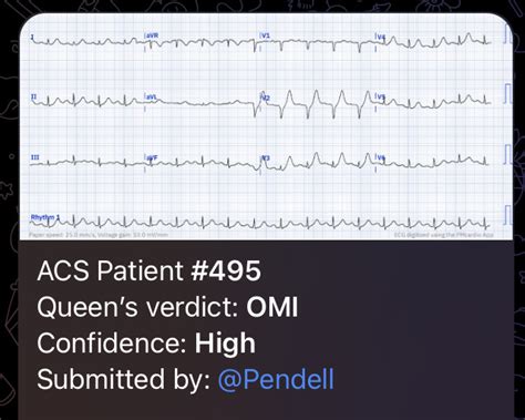 Dr Smith S ECG Blog Compare These Two ECGs Do Either Neither Or Both Show Anything Important