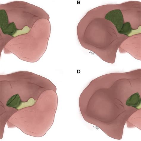Pdf State Of The Art In Subtotal Cholecystectomy An Overview