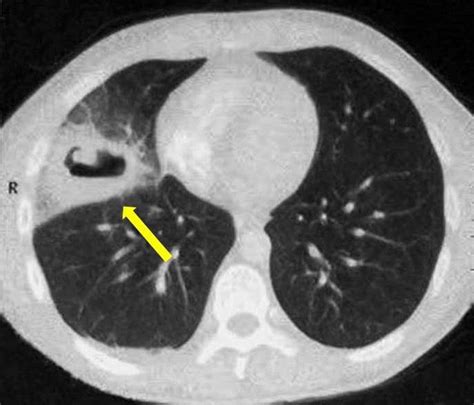 Chest Ct With Contrast Agent Axial View Showing A Rounded Lesion With