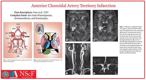 What Does The Anterior Choroidal Artery Supply At Katina Woods Blog