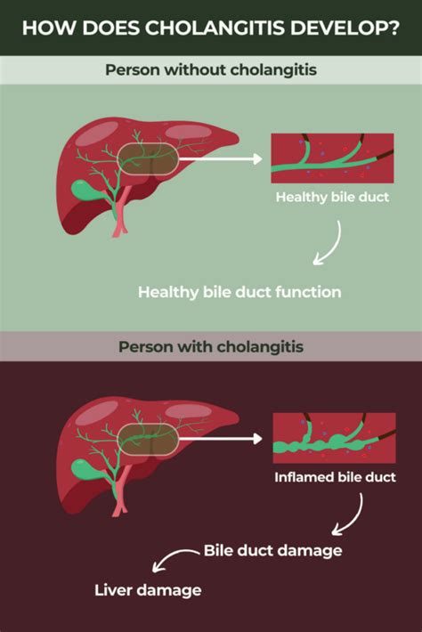 Cholangitis Causes Symptoms Treatment And More Liver Disease News
