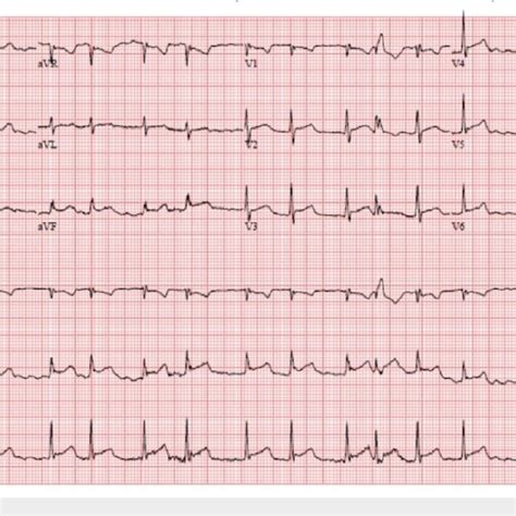 EKG Showing Atrial Fibrillation And Diffuse ST Elevations EKG Download Scientific Diagram