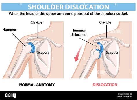 Comparison Of Normal And Dislocated Shoulder Anatomy Stock Vector Image