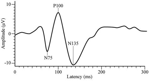Typical Transient Pattern Reversal Visual Evoked Potential Waveform