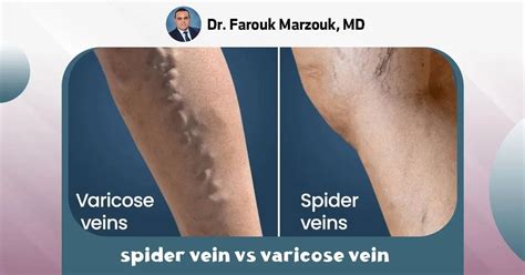 Spider Veins Vs Varicose Veins Differences And Treatment