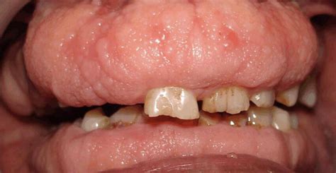 The General Appearance Of Teeth With Hereditary Gingival Fibromatosis