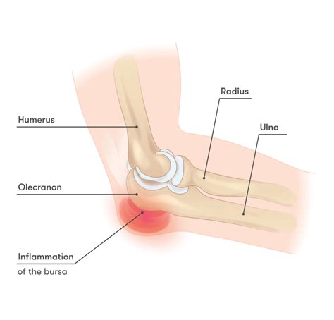 Olecranon Bursitis Lucas