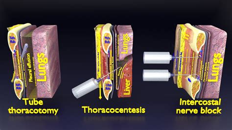Thorax Thoracotomy Thoracocentesis Intercostal Nerve Block 3d Model Superhive Formerly