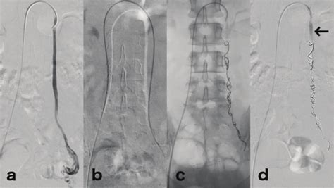 Embolization Technique A Venography Pre Embolization With Reflux In