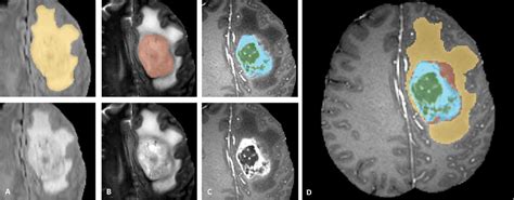 Pdf The Multimodal Brain Tumor Image Segmentation Benchmark Brats