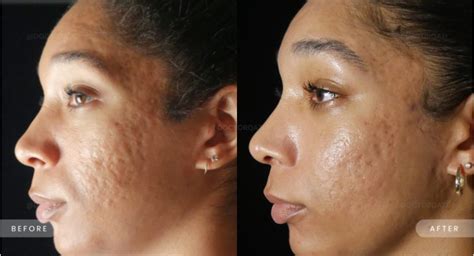 How Long Does It Take For Acne Scars To Fade