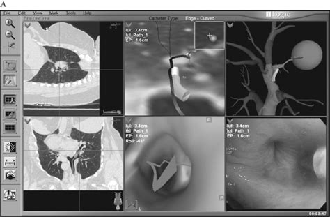 Electromagnetic Navigationassisted Bronchoscopy Operative Techniques In Thoracic And