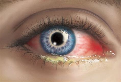 Конъюнктивит что это за болезнь Что нужно знать о конъюнктивите — Офтальмология