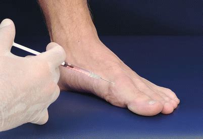 Metatarsophalangeal Joints And Mortons Neuroma Injections Anesthesia Key