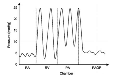 Pulmonary Artery Catheter Waveforms
