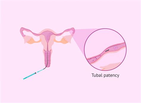 Tubal Patency In Al Ain Uae Al Ain Fertility Center