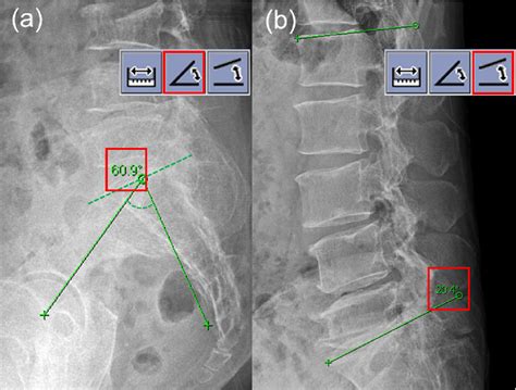 Figure 2 From Evaluation Of Sagittal Spinopelvic Alignment On Analgesic