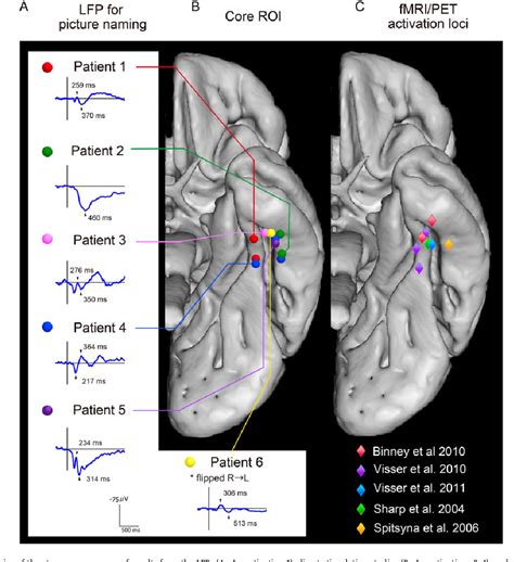 Figure 1 From Direct Exploration Of The Role Of The Ventral Anterior Temporal Lobe In Semantic