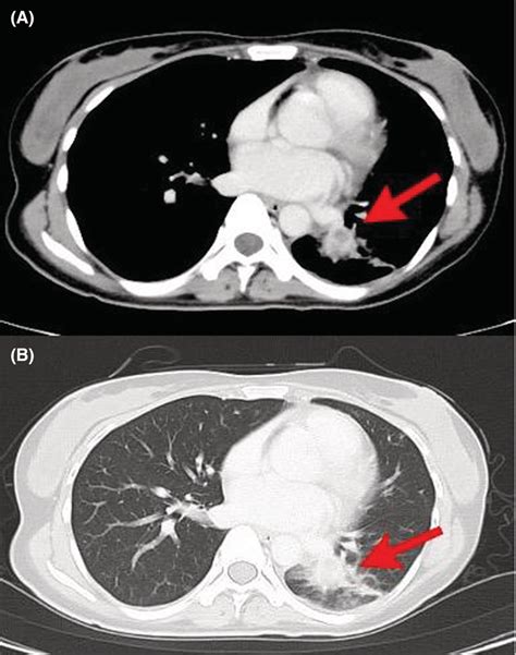 Computed Tomography Ct Of Septic Pulmonary Embolism A A Contrast Download Scientific
