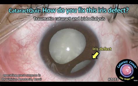Uday Devgan On Linkedin 2073 Quiz How Do You Fix This Iris Defect