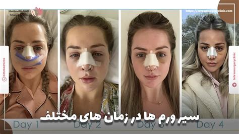 مراحل کاهش ورم بینی بعد از عمل درمان خانگی ورم بینی