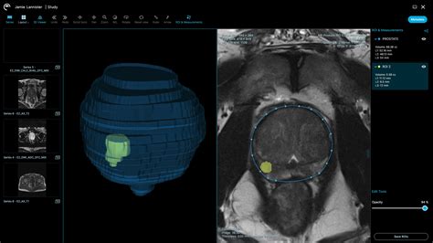 Prostate Ai Full Body Mri Screening Service By Ezra