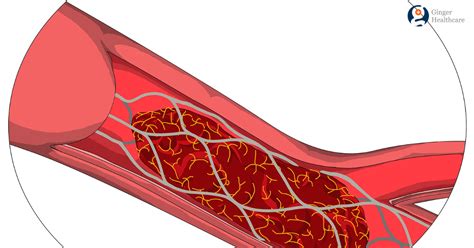 Surgical Thrombectomy Purpose Preparation Procedure Aftercare And Risks