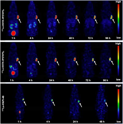 Development Of Fapi Tetramers To Improve Tumor Uptake And Efficacy Of Fapi Radioligand Therapy